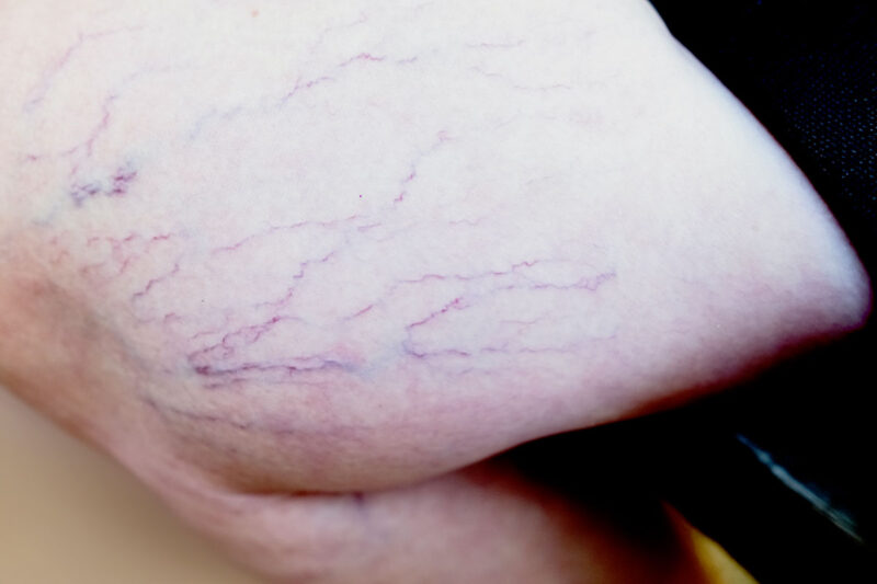 Behandlung von Besenreisern: Eine Detaillierte Übersicht