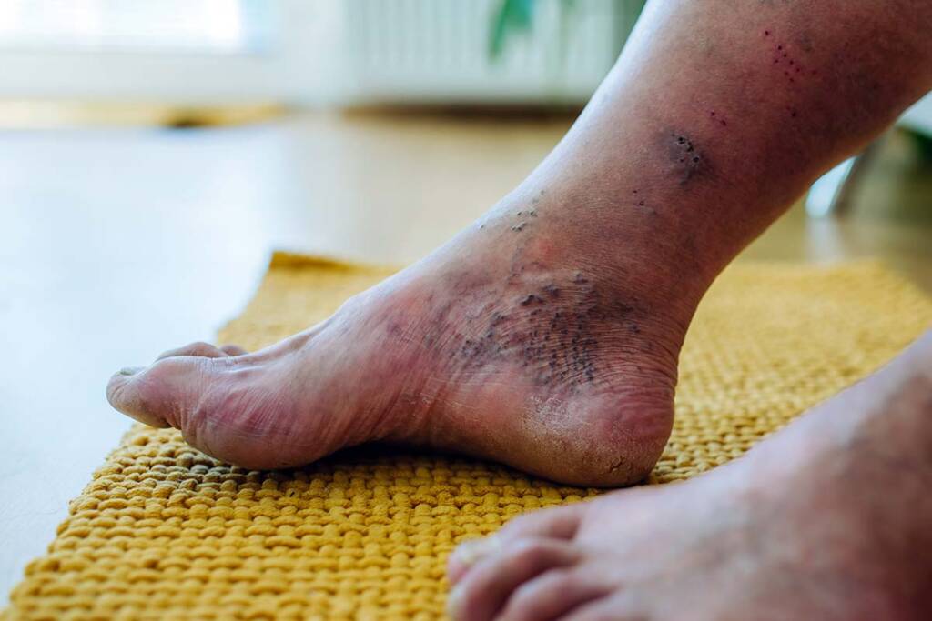 Ulcus Cruris - Causes, CVI connection & therapeutic approaches