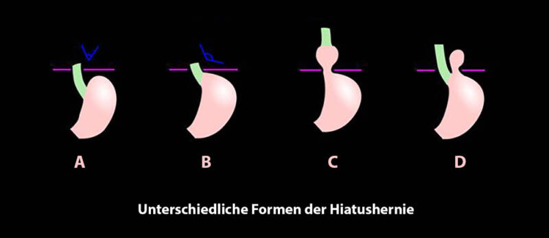 Zwerchfellbruch – Ursachen, Symptome & Therapie Berlin