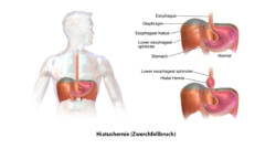 Zwerchfellbruch – Ursachen, Symptome & Therapie Berlin